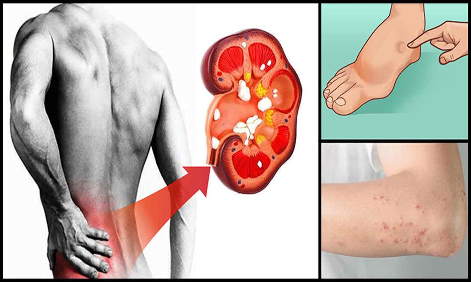 சிறுநீரக கல் பிரச்சினையா? அதற்கான தீர்வுகளும், உணவு முறைகளும் | kidney ...