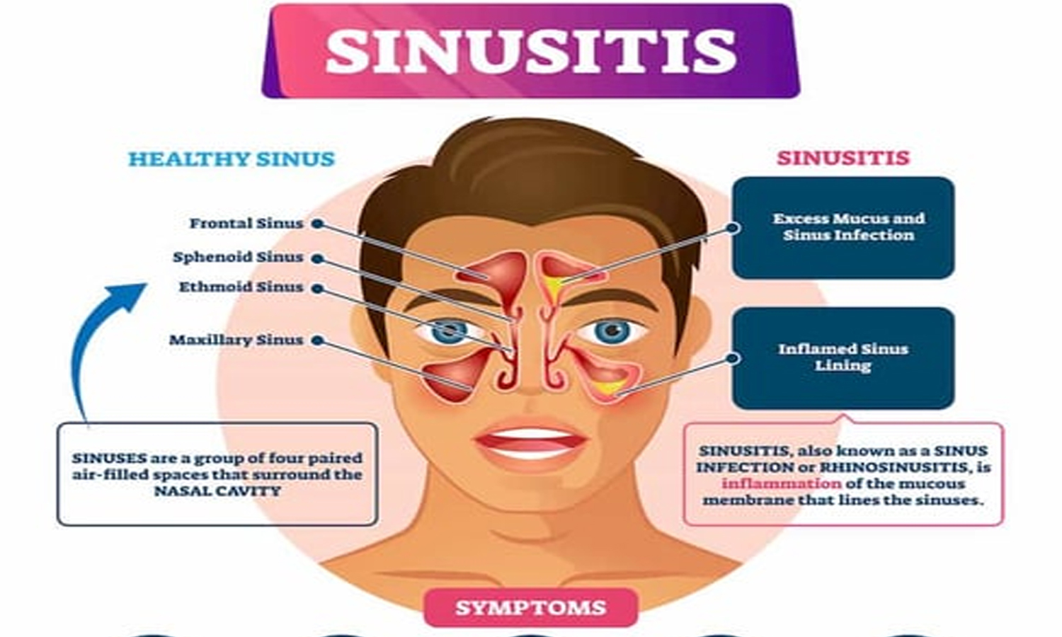 'சைனஸ்' பிரச்சினையிலிருந்து விடுபட எத்தகைய சிகிச்சை தேவை? | sinus ...