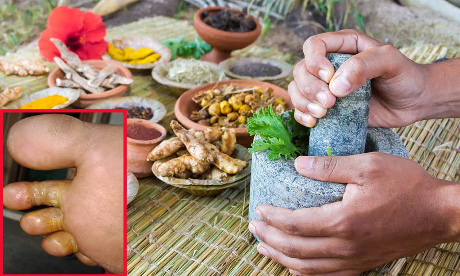 கால் விரல் இடுக்குகளில் வரும் சேற்றுப்புண்... தீர்வு தரும் சித்த ...