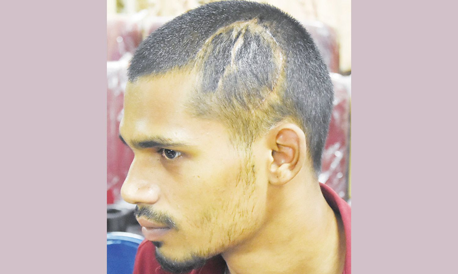 மண்டை ஓடு உடைந்தால் உலோக மண்டை ஓடு- கீழ்ப்பாக்கம் அரசு ஆஸ்பத்திரியில் ...