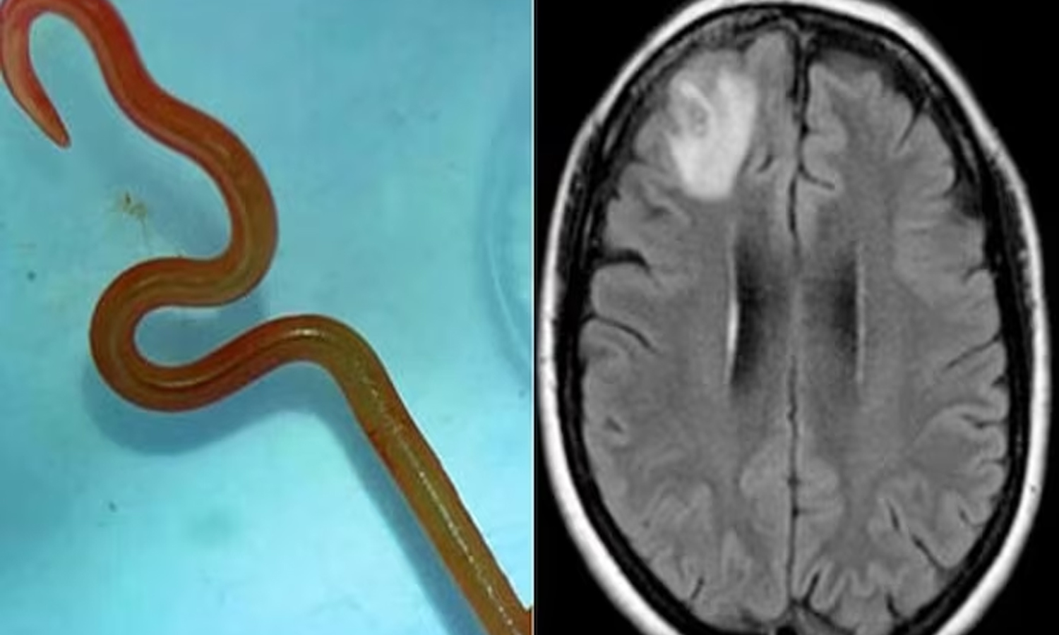 உலகிலேயே அரிய நிகழ்வு: மனித மூளையில் உயிருள்ள புழு- ஆஸ்திரேலிய ...