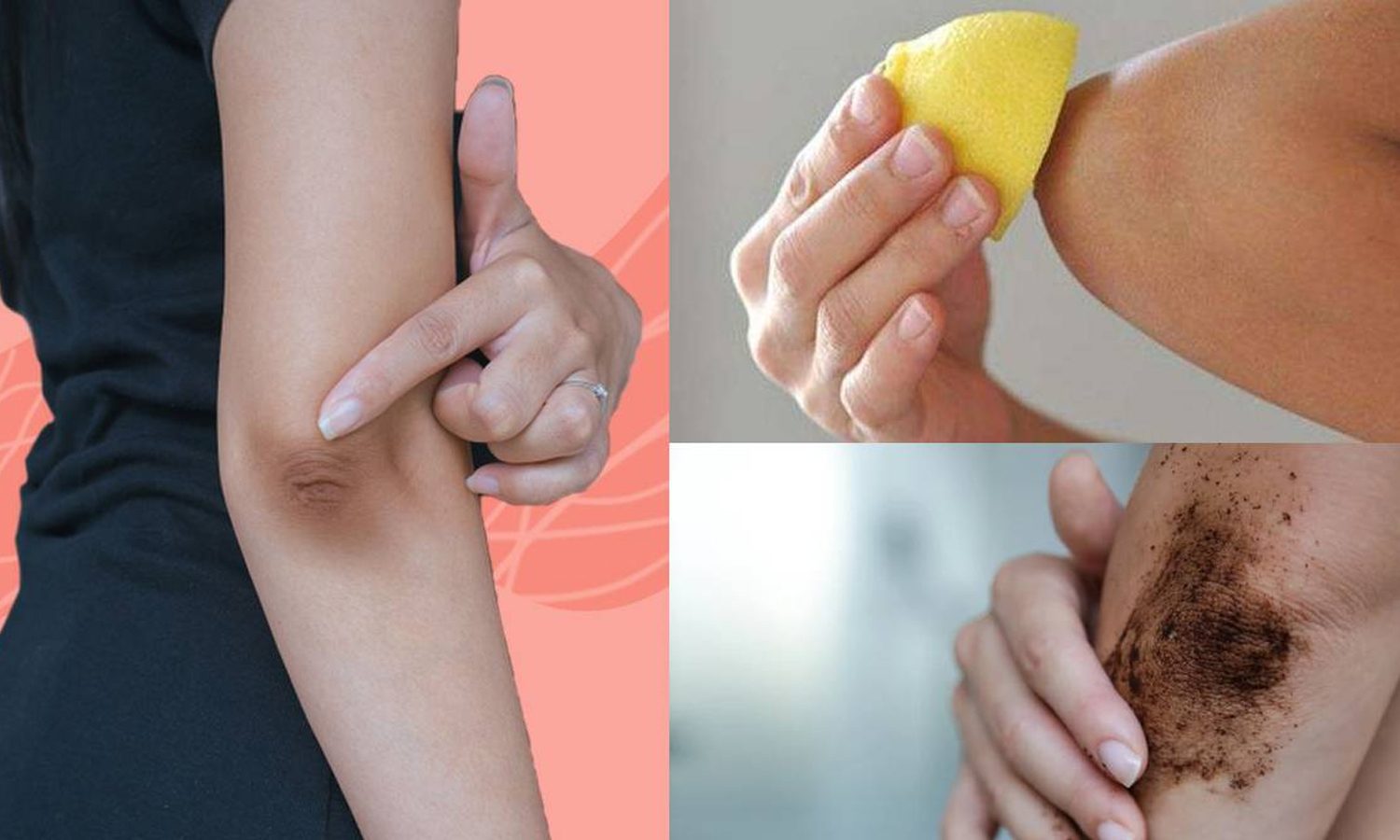 முழங்கை கருப்பை அகற்றுவது எப்படி...? | How to remove elbow uterus...?